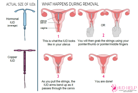 IUD Self Removal Guide | IUD Help